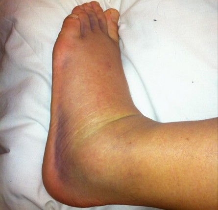 Ross Pearson publica foto de pé incrivelmente inchado, mas descarta ...